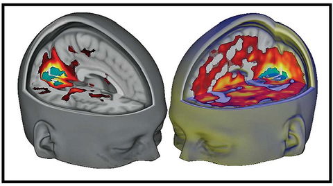 O que é LSD? Conheça seus efeitos e a história da droga - Significados